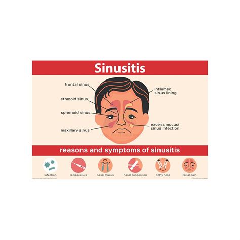 Anne Print Solutions® Sinusitis Chart Posters Without Frame Hospital