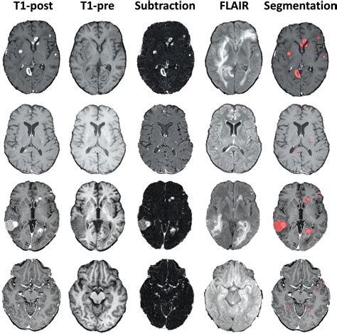 The University Of California San Francisco Brain Metastases Stereotactic Radiosurgery Ucsf