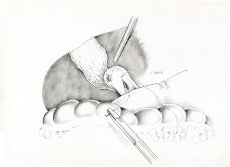 Coledocoduodenostomía Archives Dr Javier Martín Delgado