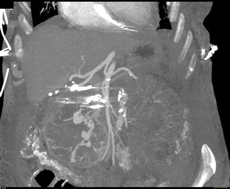 Active Bleed In A Duodenal Gist Tumor Small Bowel Radiology Case