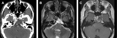 Osseous Fibro Osseous And Cartilaginous Lesions Of The Skull Base And Facial Bones Advances