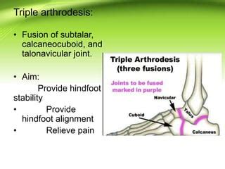 Triple Arthrodesis Ppt