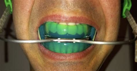 Bite Block Braces For Fun