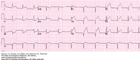 Ecg Abnormalities Anesthesia Key