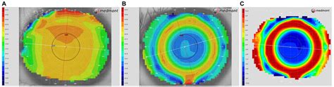 Corneal Topography Tangential Eye Maps Obtained A Before Fitting And Download Scientific