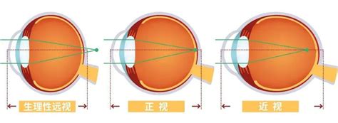 眼轴的增长一定会带来近视度数的增加么？家长必读 知乎