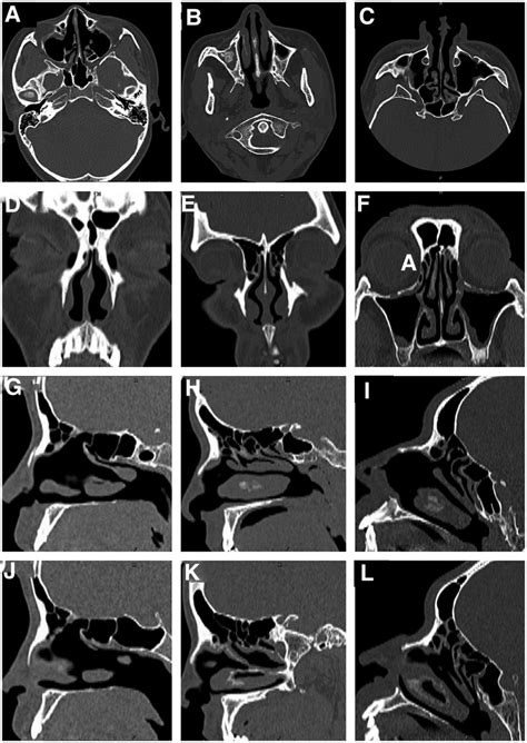 Preoperative Thin Slice Ct Examination Of Paranasal Sinus In Patients