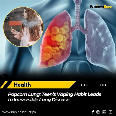 A Teenager Secretly Vaping For Three Years Developed A Severe