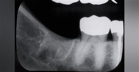 What Are The Implications Of Residual Root Sockets Registered Dental