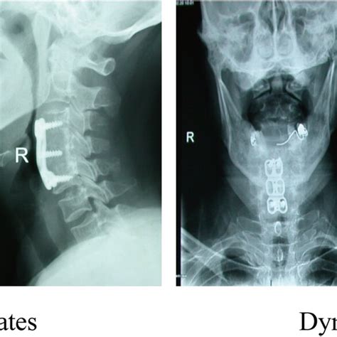X Ray View Of Anterior Cervical Corpectomy And Fusion Post Operation Download Scientific