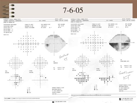 Ppt Optic Atrophy And Altitudinal Visual Field Loss Powerpoint