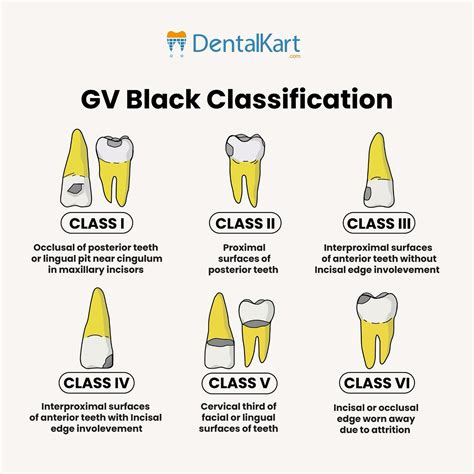 Dentalkart Gv Black S Classification Developed By Dr Facebook