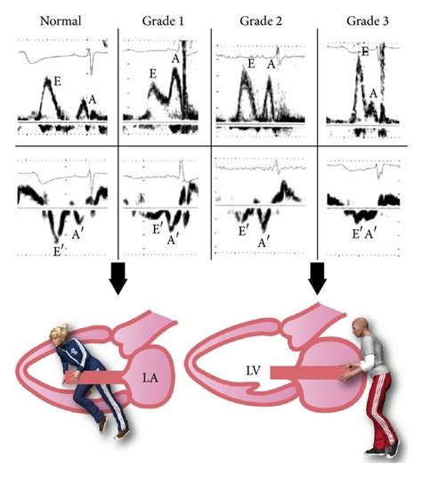 Grade One Shows A Reduced E A Ratio Mitral Inflow Measured By Download Scientific Diagram
