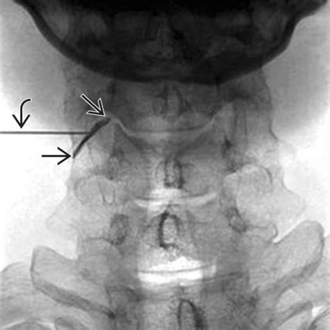 Selective Nerve Root Block Cervical Spine Clinical Tree Selective Nerve Root Block Cervical Spine Clinical Tree