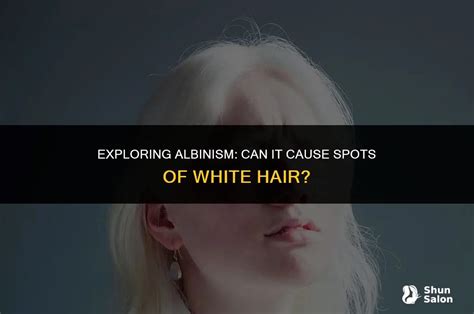 Exploring Albinism Can It Cause Spots Of White Hair Shunsalon