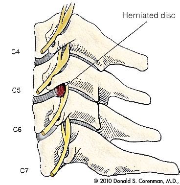 What Is C6 C7 Radiculopathy