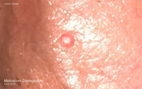 Molluscum Contagiosum Pubic Area