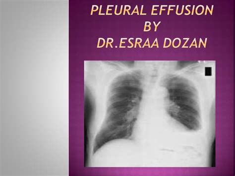 Pleural Effusionx Ray Findings Pdf