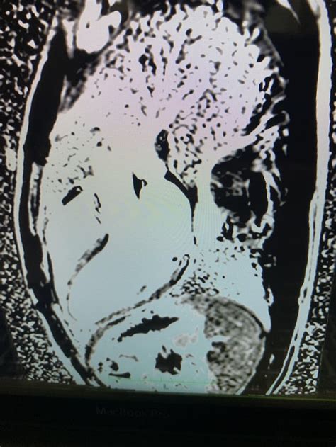 Fibrosis Or Not R Pvcs
