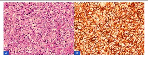 Figure 2 From Extranodal Follicular Dendritic Cell Sarcoma Of The Head And Neck Region A
