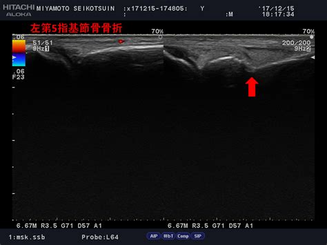 左第5指 基節骨骨折ー宇治市 六地蔵 みやもと整骨院ー宇治市六地蔵駅伏見山科最寄りのみやもと整骨院