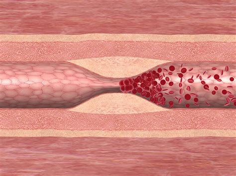 Arteriosklerose Und Parodontitis Dms Deutsche Mundgesundheitsstiftung