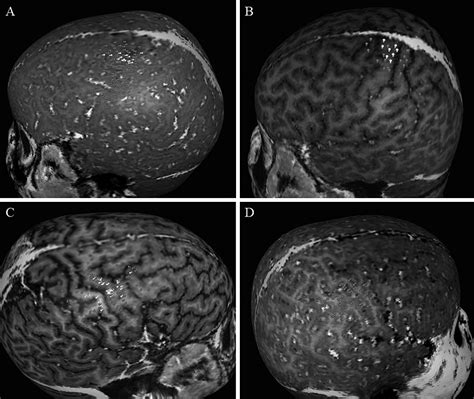 Navigated Transcranial Magnetic Stimulation Mapping Of The Motor Cortex For Preoperative