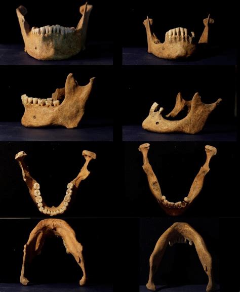 Representative Male Left And Female Right Mandible And Criteria For