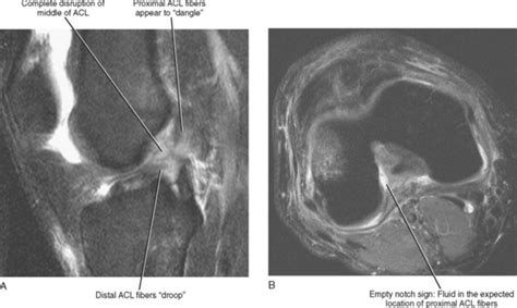 Imaging Of The Knee Radiology Key