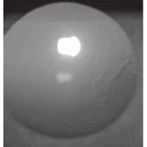 Pdf Posterior Polymorphous Corneal Dystrophy In X Linked Alport Syndrome