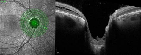 Acquired Optic Disc Pit Secondary To Glaucoma Retinara
