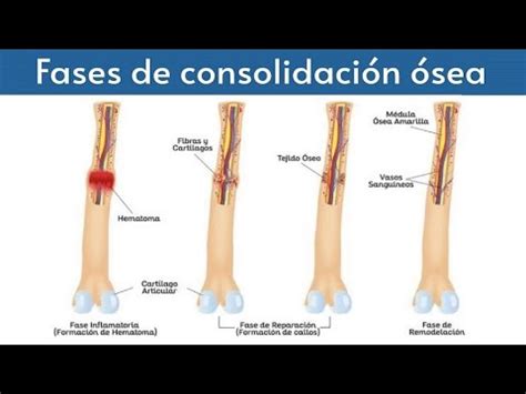 🔴 Como Se Recupera Un Hueso Despues De La Fractura Fases De