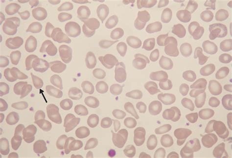 Resumo De Alterações Morfológicas Dos Eritrócitos Tamanho Coloração E