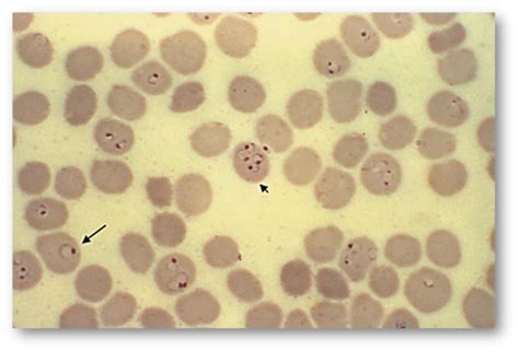 43 Malaria Flashcards Quizlet 43 Malaria Flashcards Quizlet