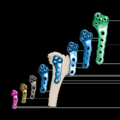 Tplo Fusion Implants