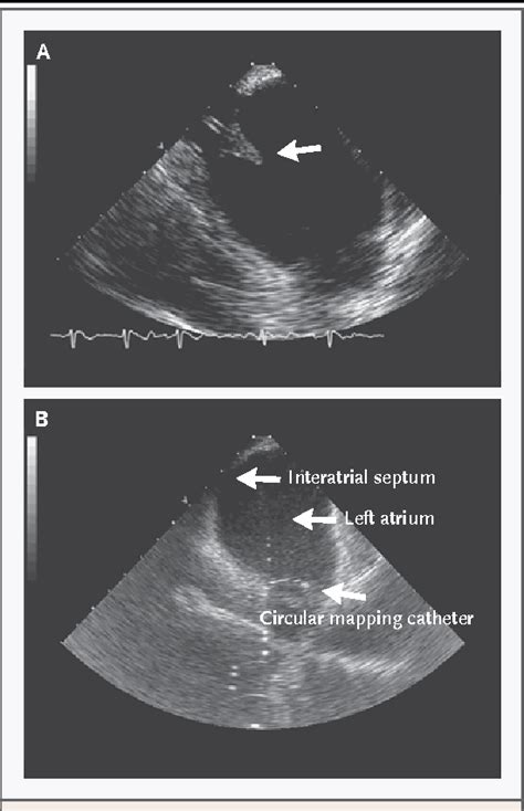 Figure 4 From Catheter Ablation For Atrial Fibrillation Semantic Scholar