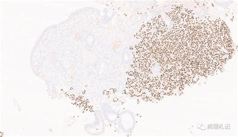 56岁女性，子宫异常出血。这些免疫组化标志物是什么 医学界 助力医生临床决策和职业成长
