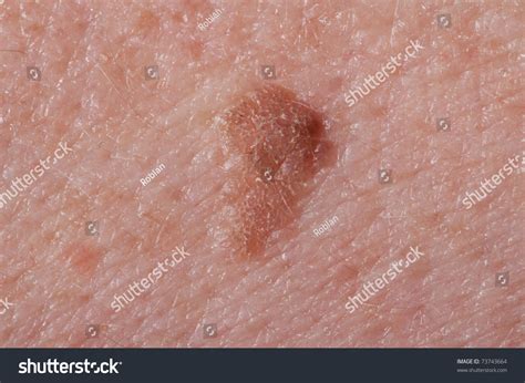 What Are Liver Spots On Skin