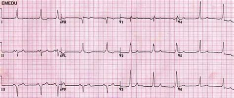 Atrial Fibrillation Flutter Flashcards Quizlet