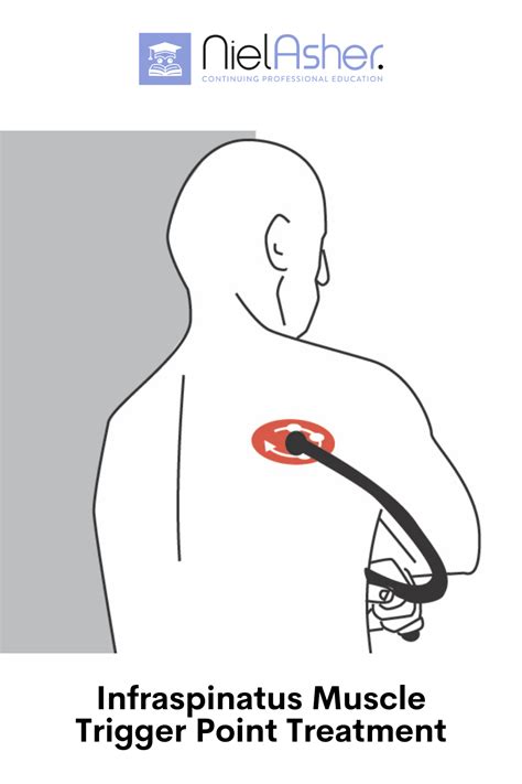 Rotator Cuff Injury Healing Artofit