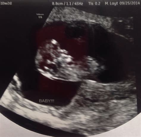 Transvaginal Or Pelvic Ultrasound 105 Wks — The Bump