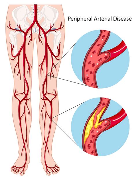 What Causes Peripheral Artery Disease Wkwi