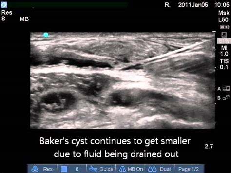 View 28 Bakers Cyst Knee Ultrasound