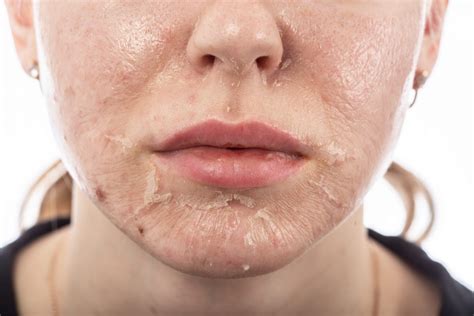 7 Chemical Peeling Secrets You Should Know Before Opting For It