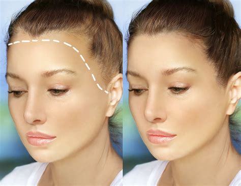 Frontal Fibrosing Celebrity Female Hair Loss 60 Photos