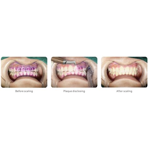 Ap B Dental Air Polisher And Ultrasonic Scaler Unit Bdsi Dental Consumables And Equipment