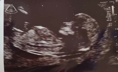 Ultrasound Sex Prediction Mumsnet