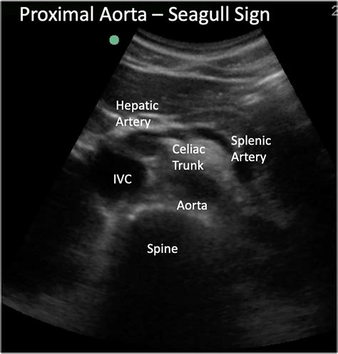 Ultrasound Of The Aorta Emergency Medicine Clinics