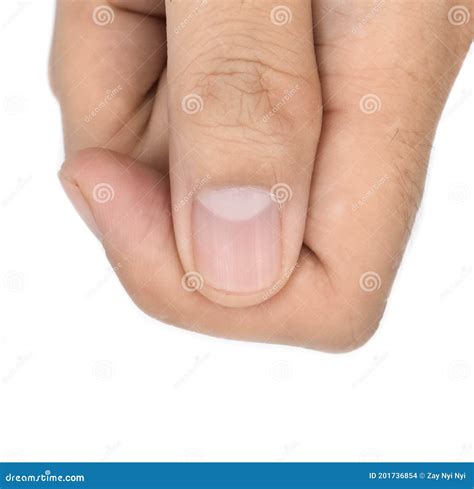 Small Lunulae Or Half Moons At Fingernails With Longitudinal Lines Of