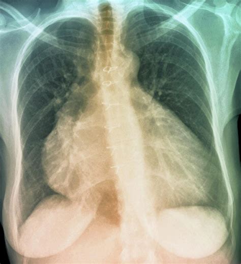 Enlarged Heart 5 By Science Photo Library